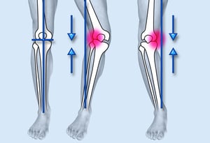 Everything You Need To Know About Bowleg Correction