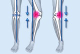 Everything You Need To Know About Bowleg Correction