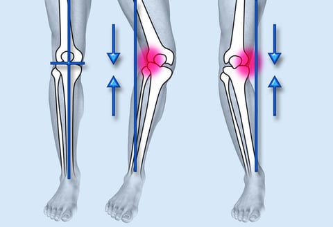 How Bow Legs Surgery can Help Your Diagnosed Genu Varum.