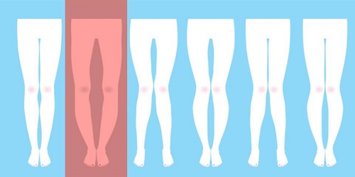 Suffer From Bowed Legs? Your Orthopedic Surgeon Has Answers!